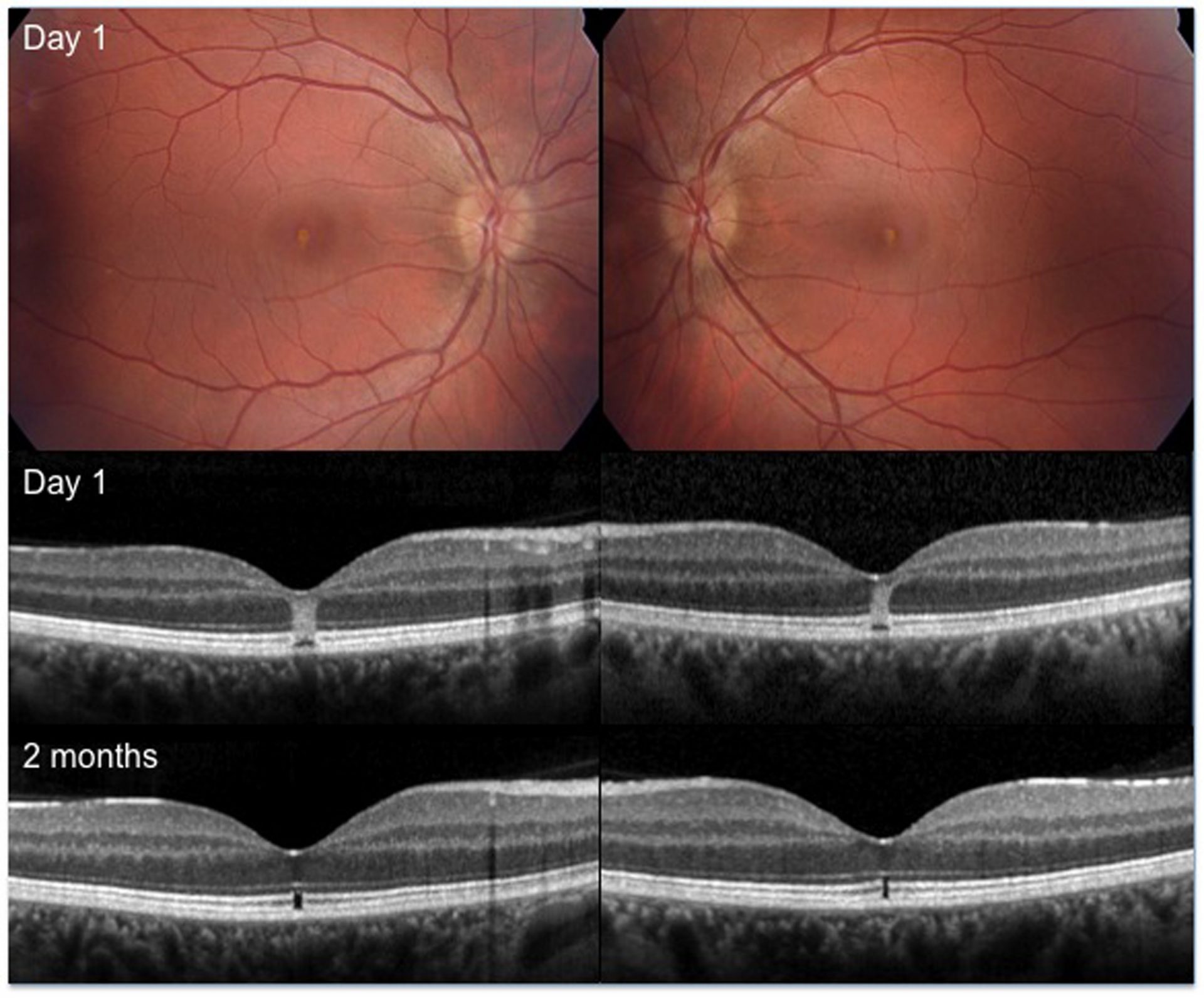 What Sun Damage On Your Eyes Looks Like - Eye Solutions